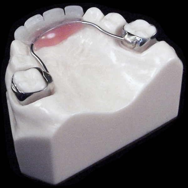 prótese dentária fixa em criança dente anterior - Luís Gustavo Leite ...