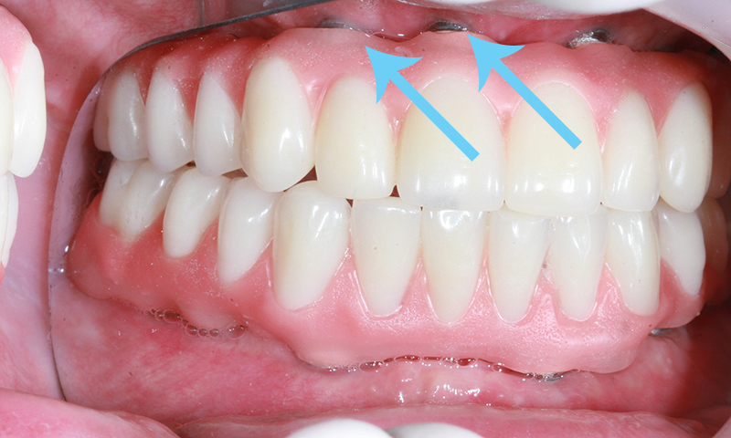 Prótese dentária protocolo: conheça os tipos e materiais mais utilizados.