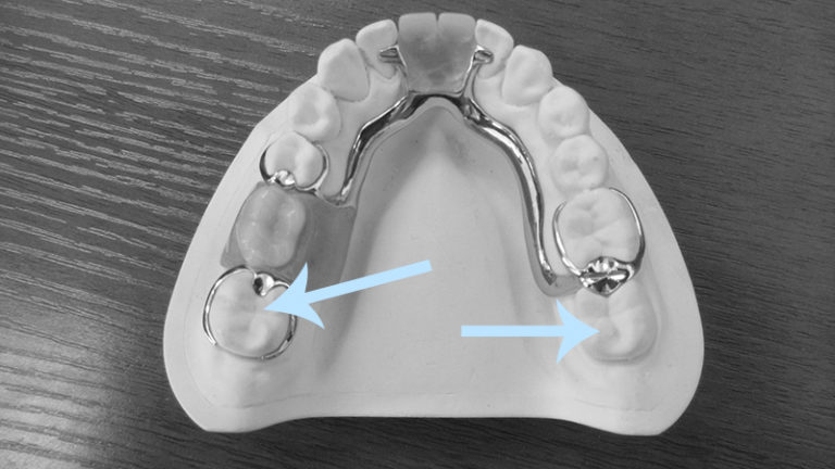 Prótese dentária móvel: os tratamentos e tipos de pontes removíveis.