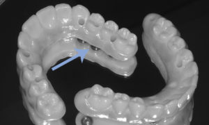 Prótese protocolo em porcelana ou zircônia: diferenças além do preço.