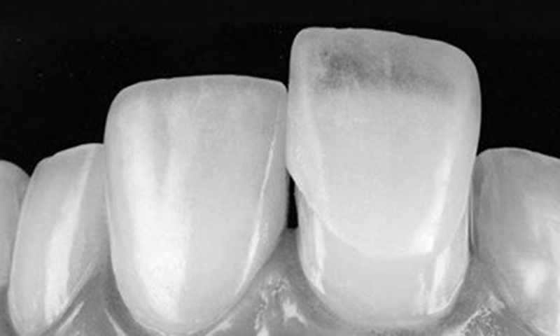 faceta dentaria lente de contato dental indicações - Luís Gustavo Leite ...