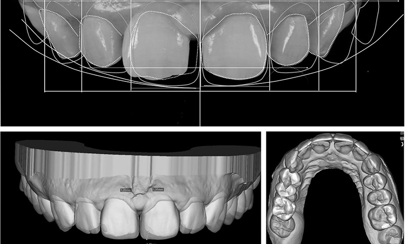 Faceta dentária: conheça os detalhes da técnica para transformar sorrisos.