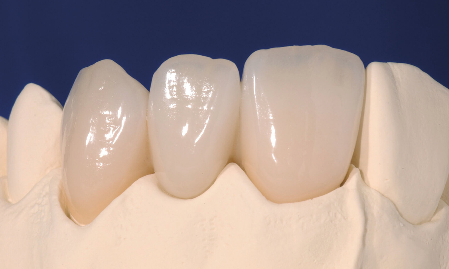 Prótese dentária: selecione o melhor material para estética de impacto.