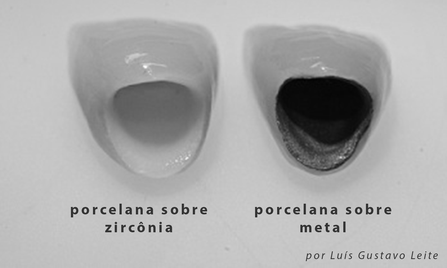 Prótese dentária em zircônia: indicações, prós e contras.