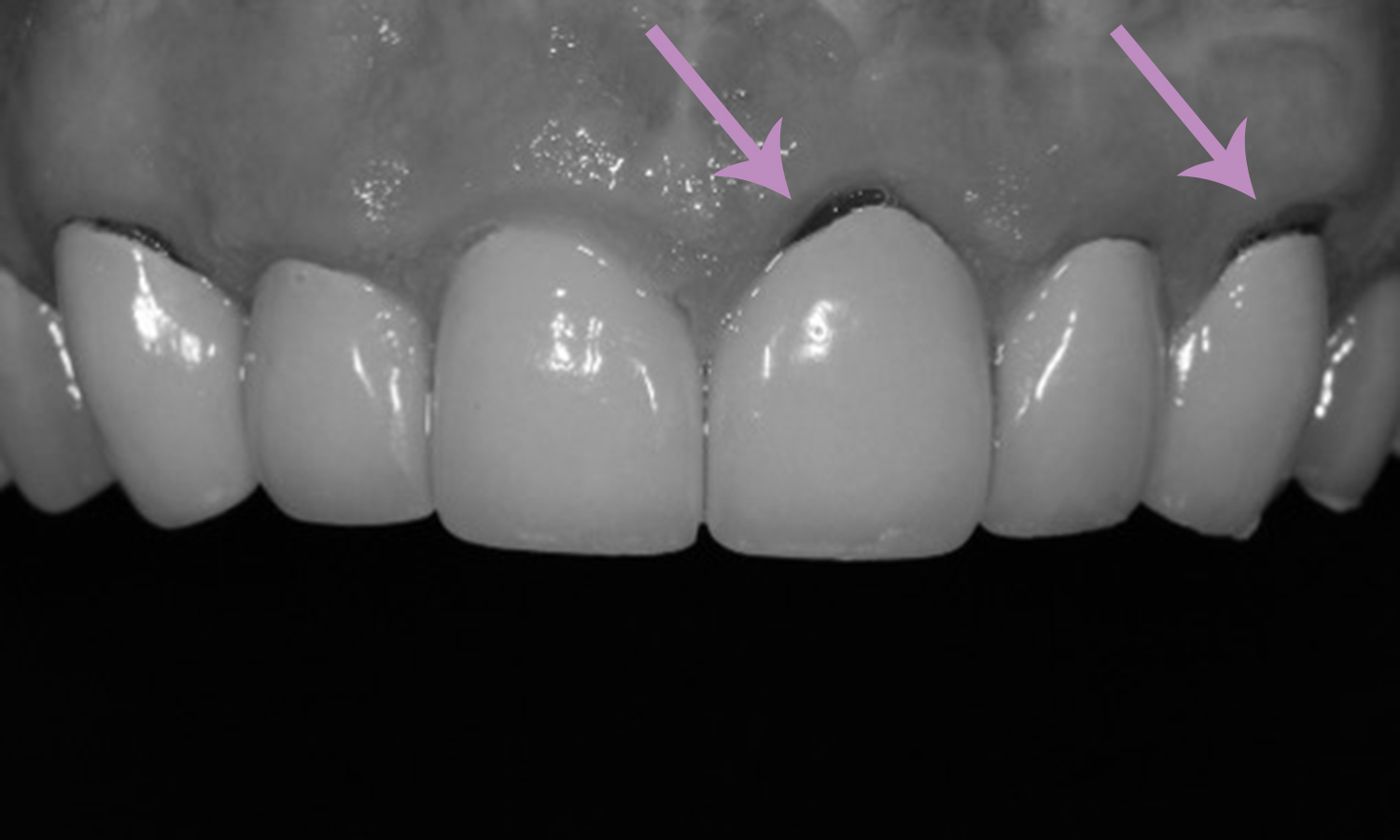 Prótese dentária fixa: melhor material e técnica super explicados.