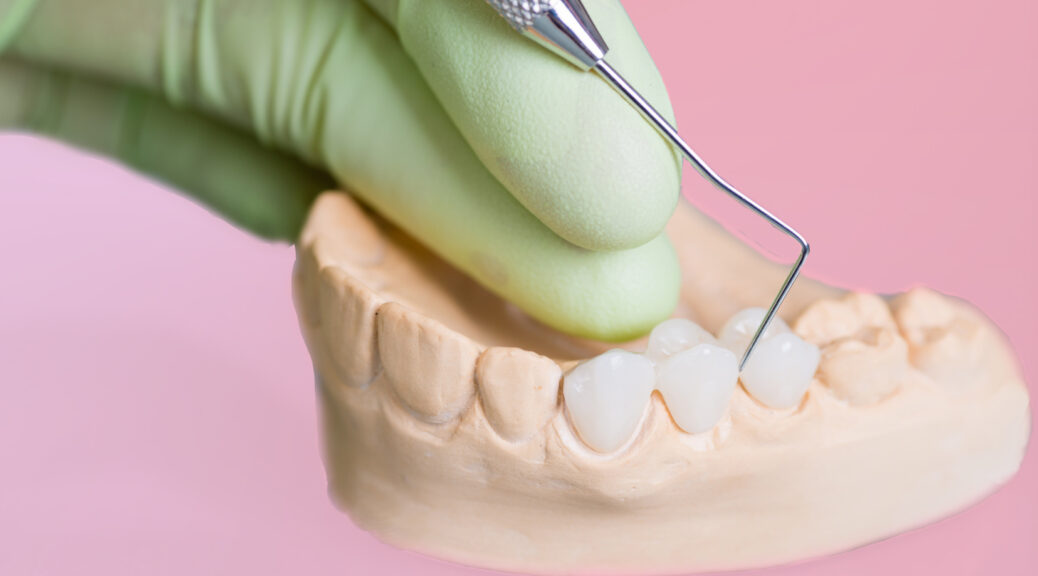 Prótese dentária fixa: o que é, os tipos e o melhor material explicados.