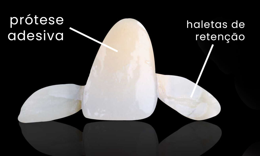 Prótese adesiva em porcelana pode ser alternativa ao implante dentário.